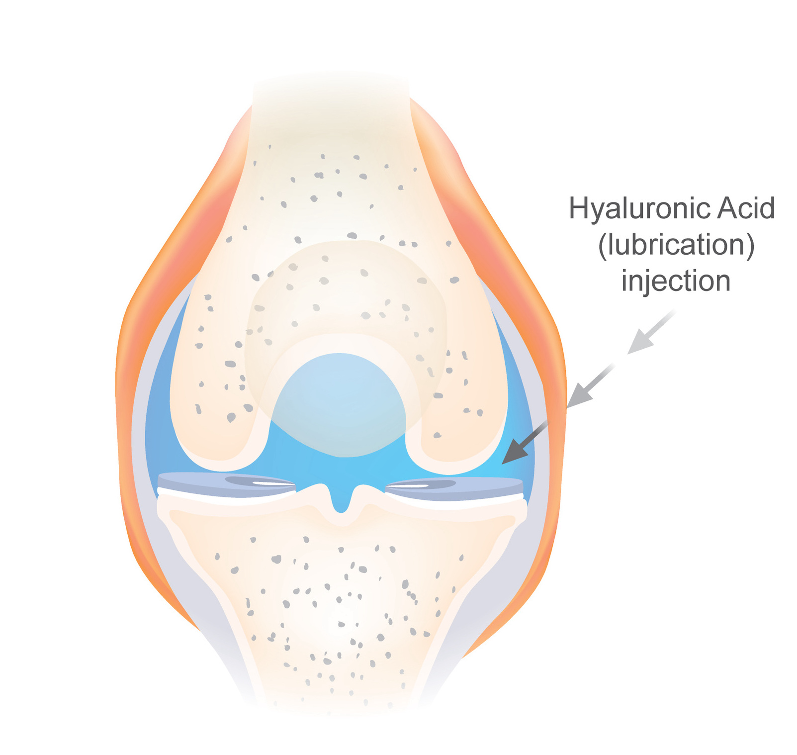 Injections – Solutions Regenerative Medicine